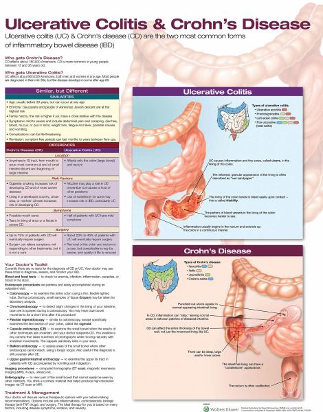 Ulcerative Colitis And Crohn's Disease Laminated Chart | University of ...